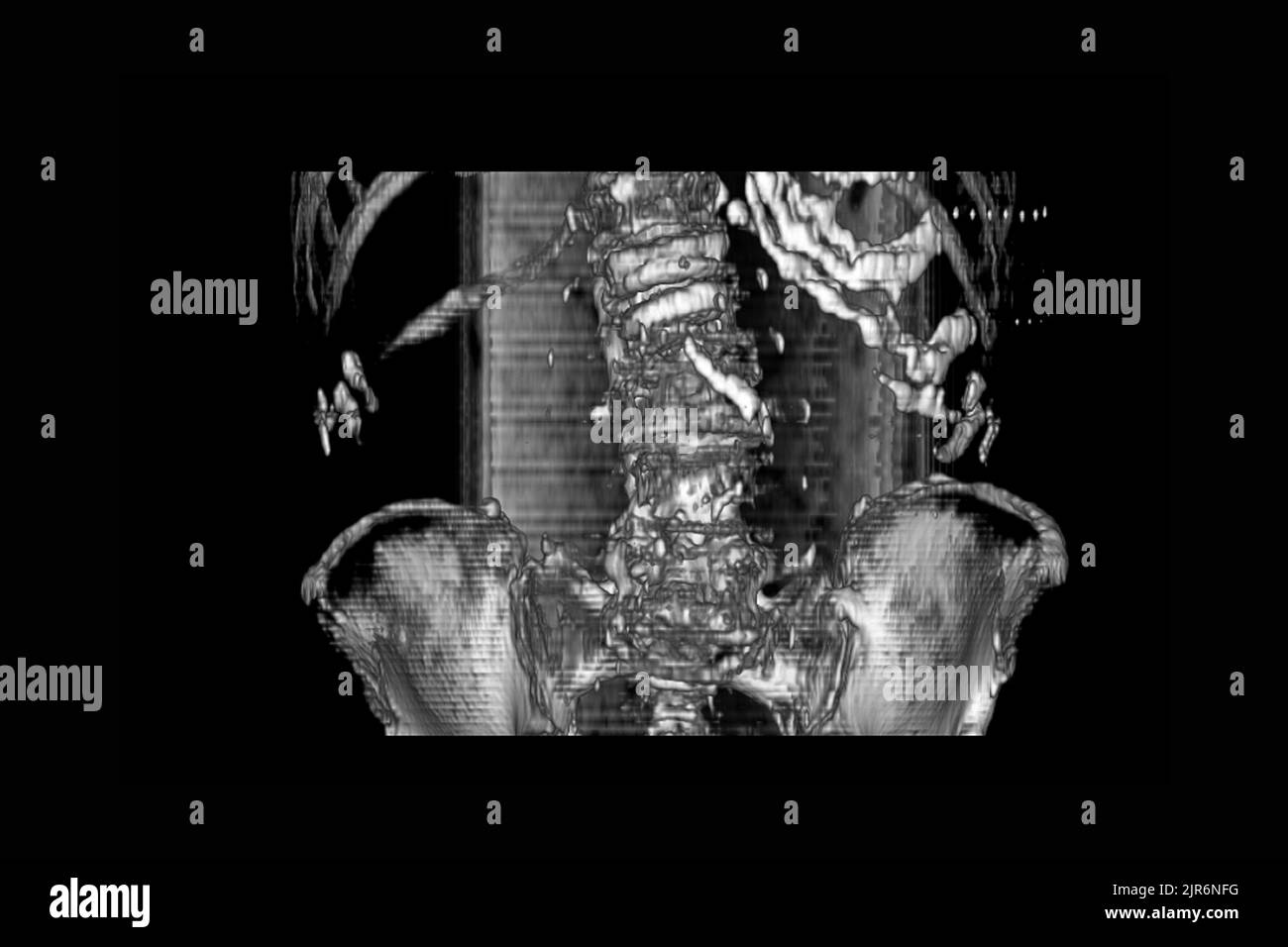 tomodensitométrie de la colonne vertébrale avec une fracture des ...