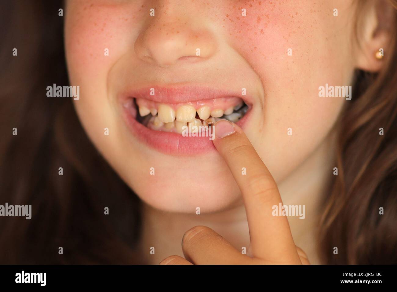 la petite fille ouvre sa bouche et montre une dent malade. caries sur une dent de bébé. Soins ...