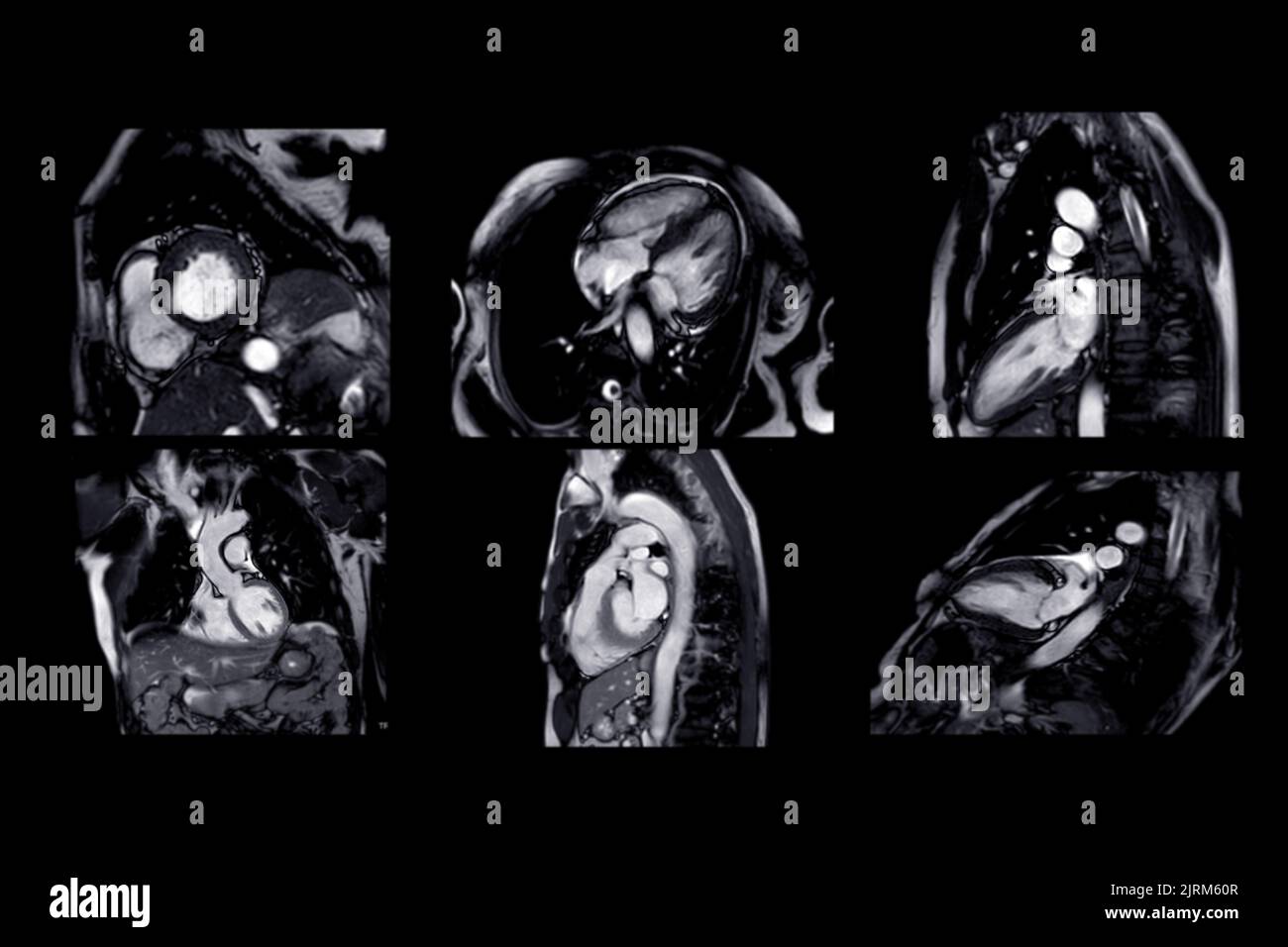 Collection d'IRM cardiaque ou cardiaque IRM ( imagerie par résonance ...