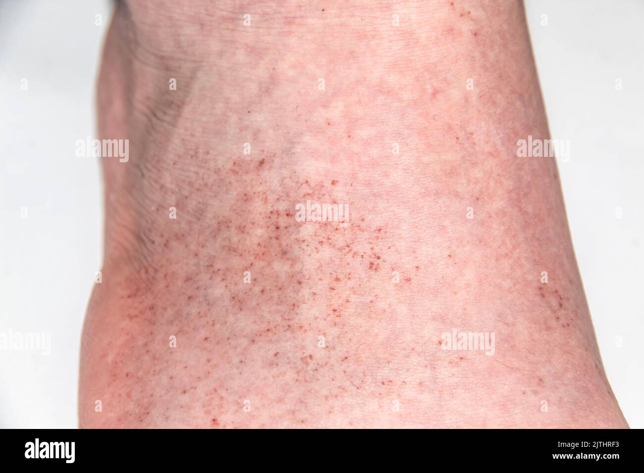 érosion allergique Banque de photographies et d’images à haute ...