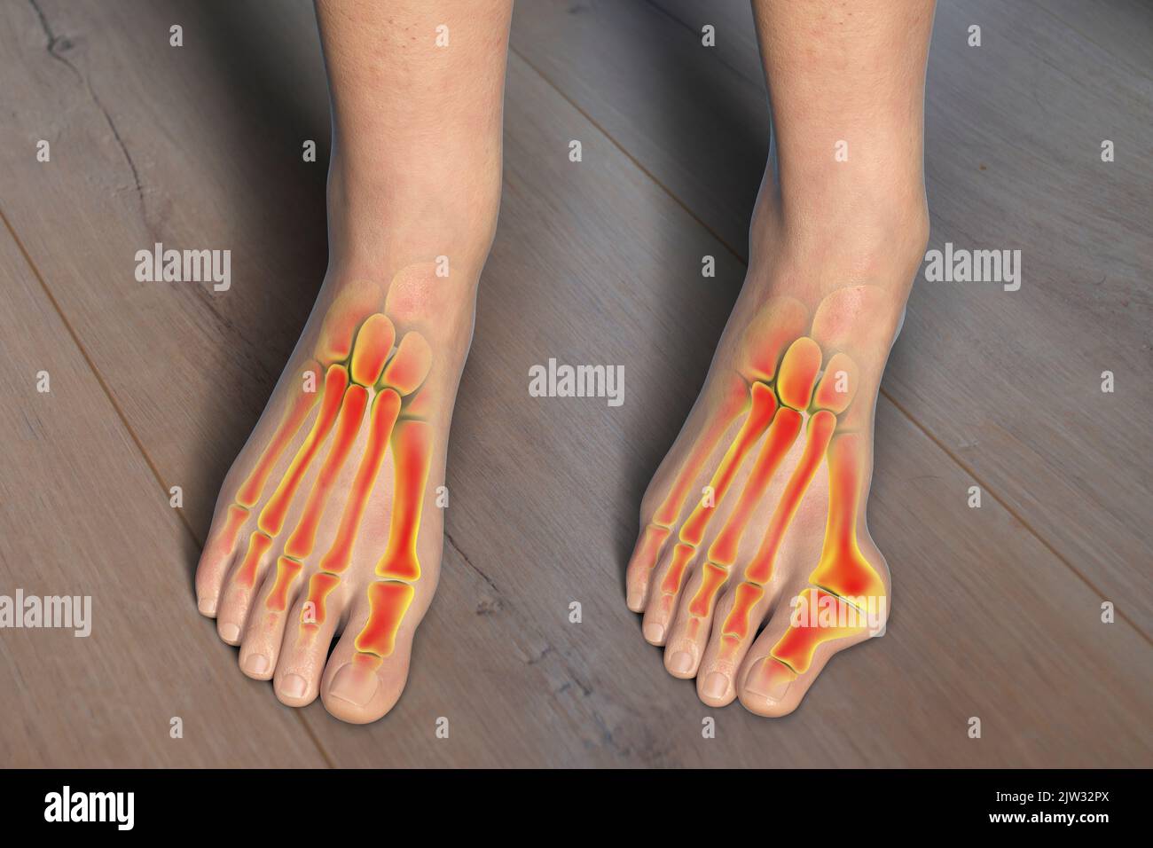 Hallux valgus, illustration. Un hallux valgus, ou Boignon, est une ...
