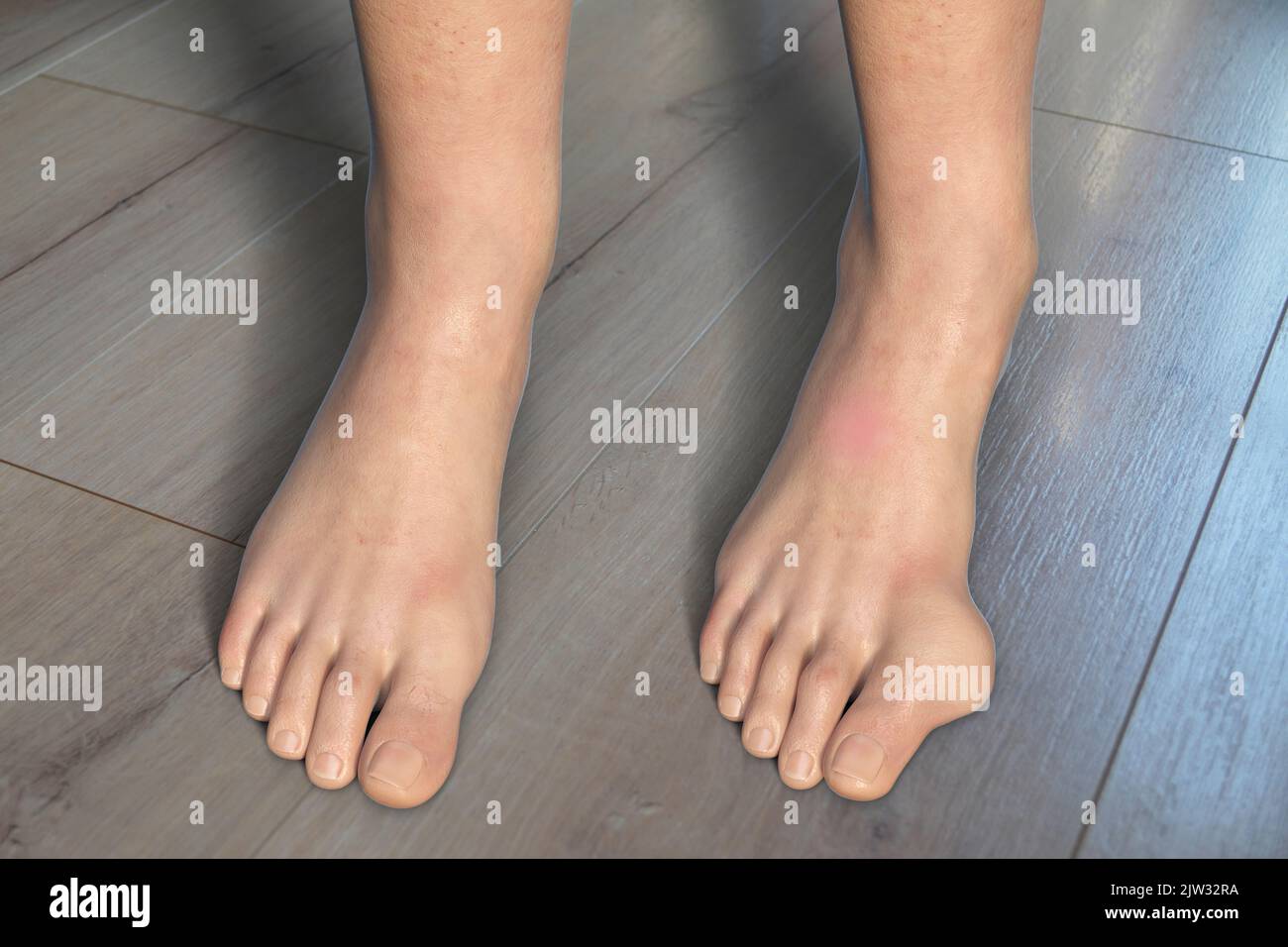 Hallux valgus, illustration. Un hallux valgus, ou Boignon, est une ...