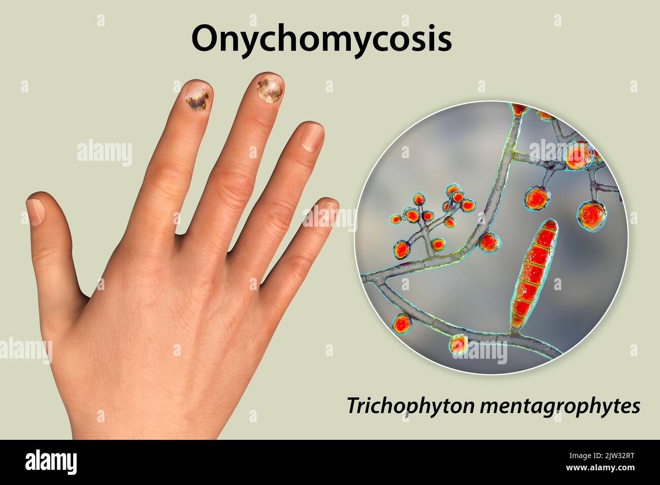 Illustration d'une infection fongique des ongles montrant une main ...