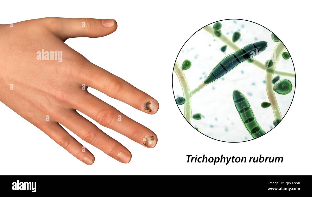 Illustration d'une infection fongique des ongles montrant une main ...
