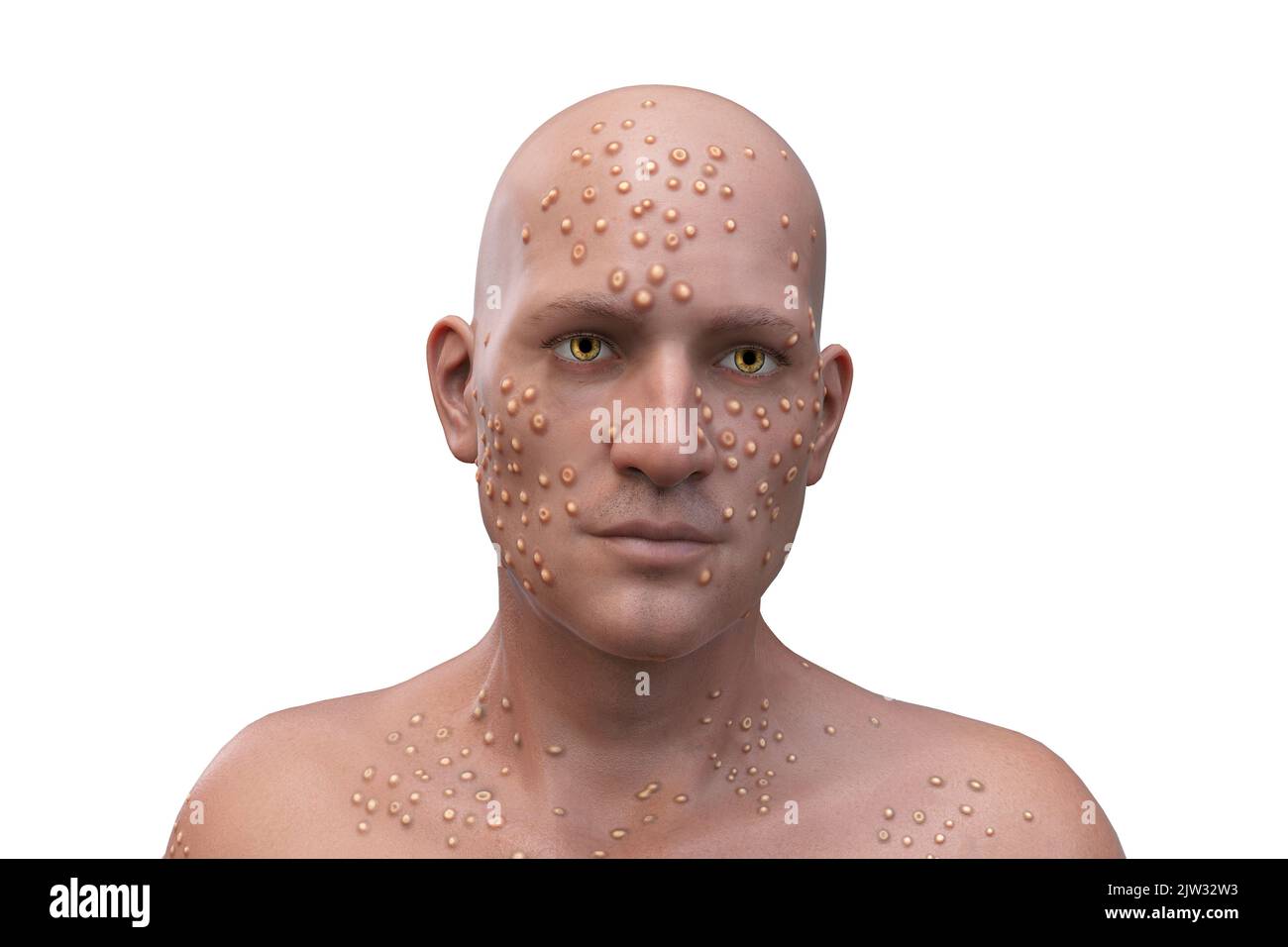 Smallpox skin lesions Banque de photographies et d’images à haute ...