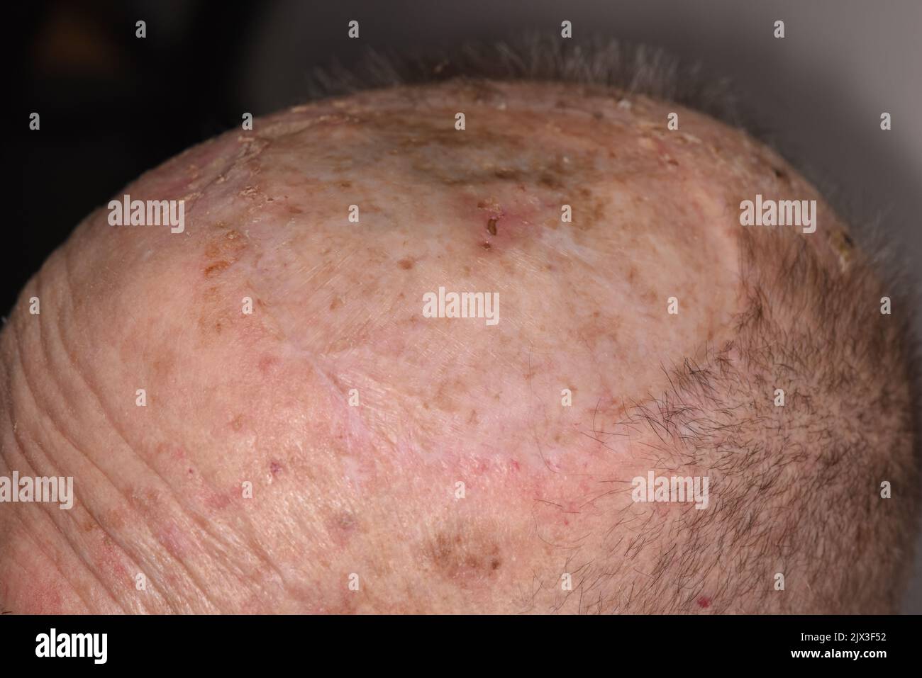 Kératoses actiniques sur le cuir chevelu d'un homme de 77 ans avec une ...