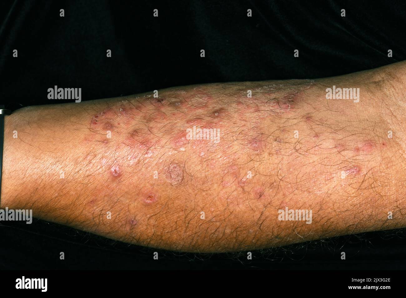 Éruption cutanée sur le membre d'un homme hispanique de 50 ans atteint ...