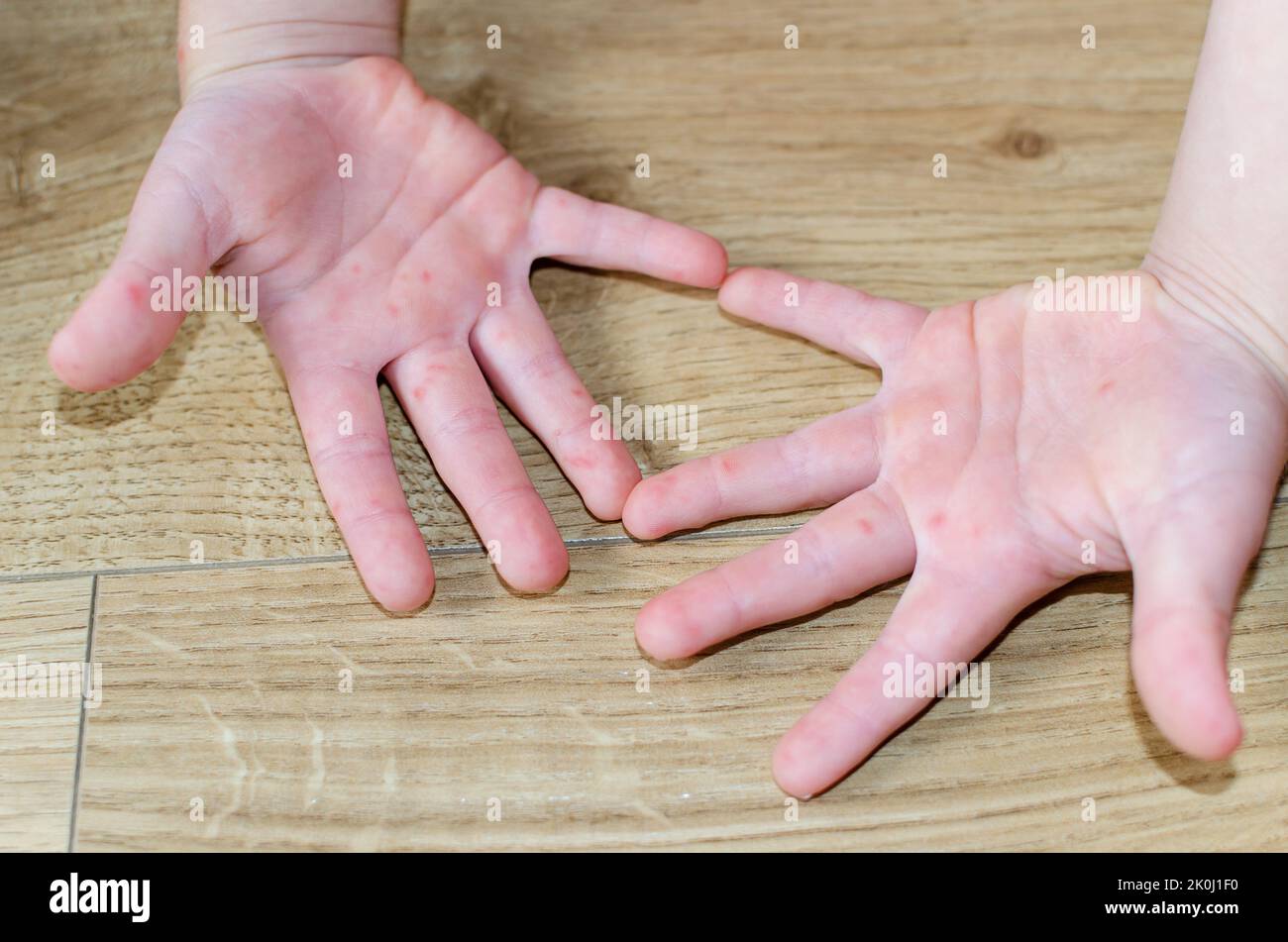 Éruption cutanée à l'entérovirus sur le corps d'un enfant. Éruption du ...