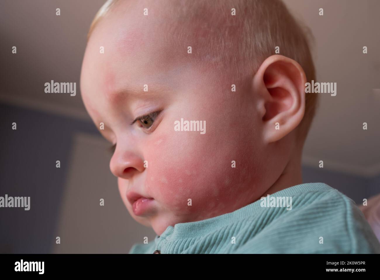 Allergie à une éruption cutanée d'ortie sur le visage d'un enfant du ...