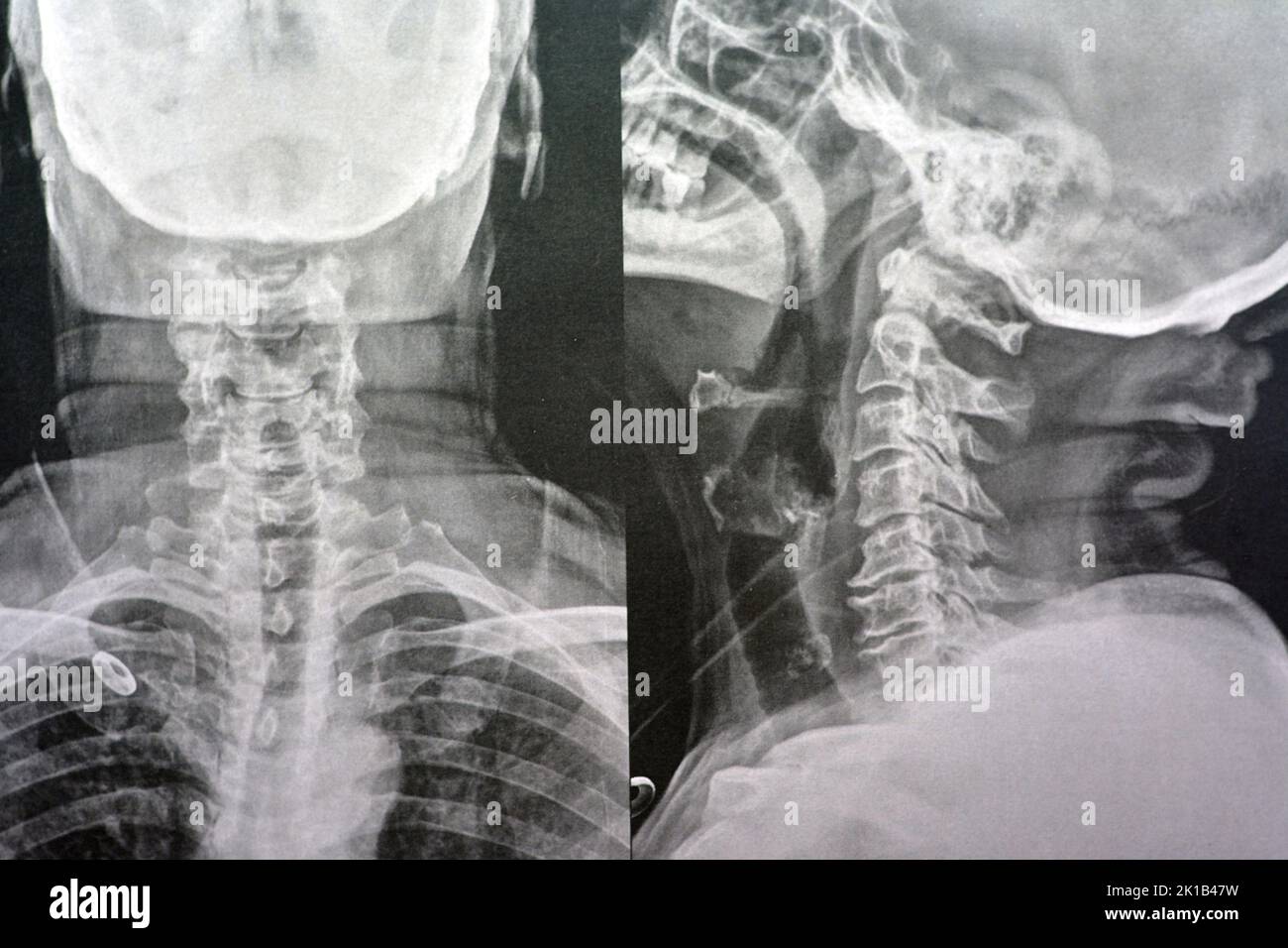 Vertèbres cervicales à rayons X simples montrant le redressement des ...