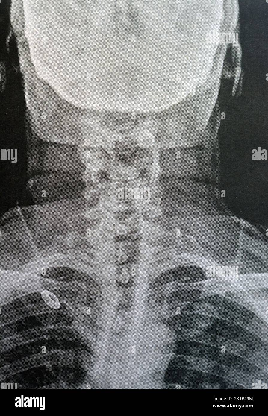 Vertèbres cervicales à rayons X simples montrant le redressement des ...