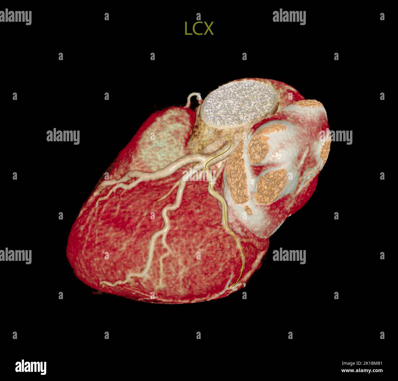 TDM cardiaque 3D ou CTA artère coronaire pour la prévention des ...