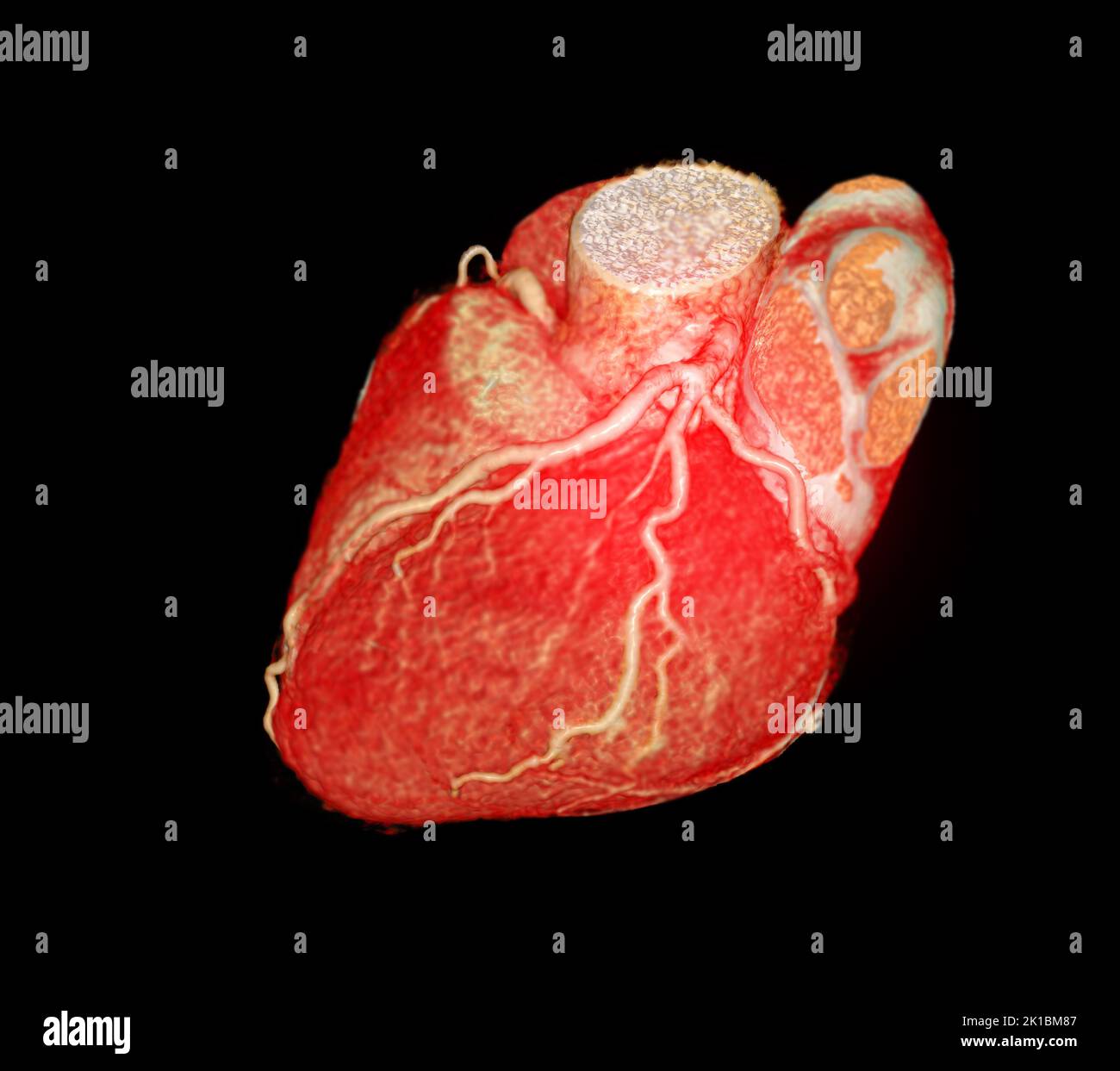 TDM cardiaque 3D ou CTA artère coronaire pour la prévention des ...
