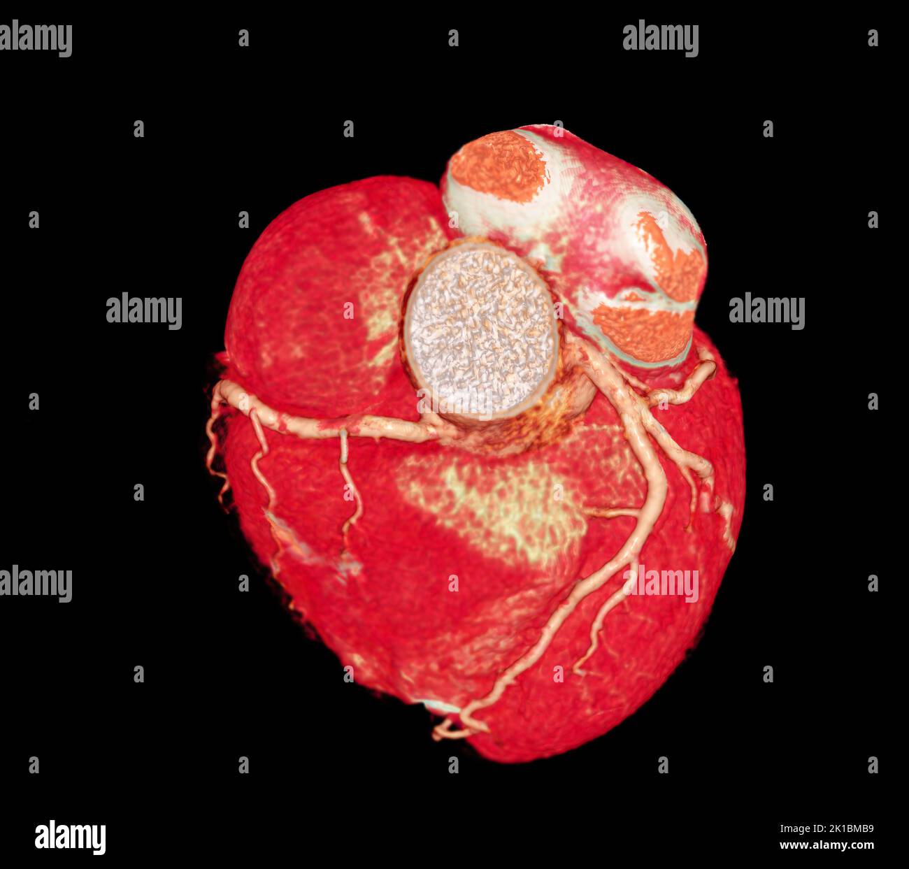 Coronary angiography Banque de photographies et d’images à haute ...