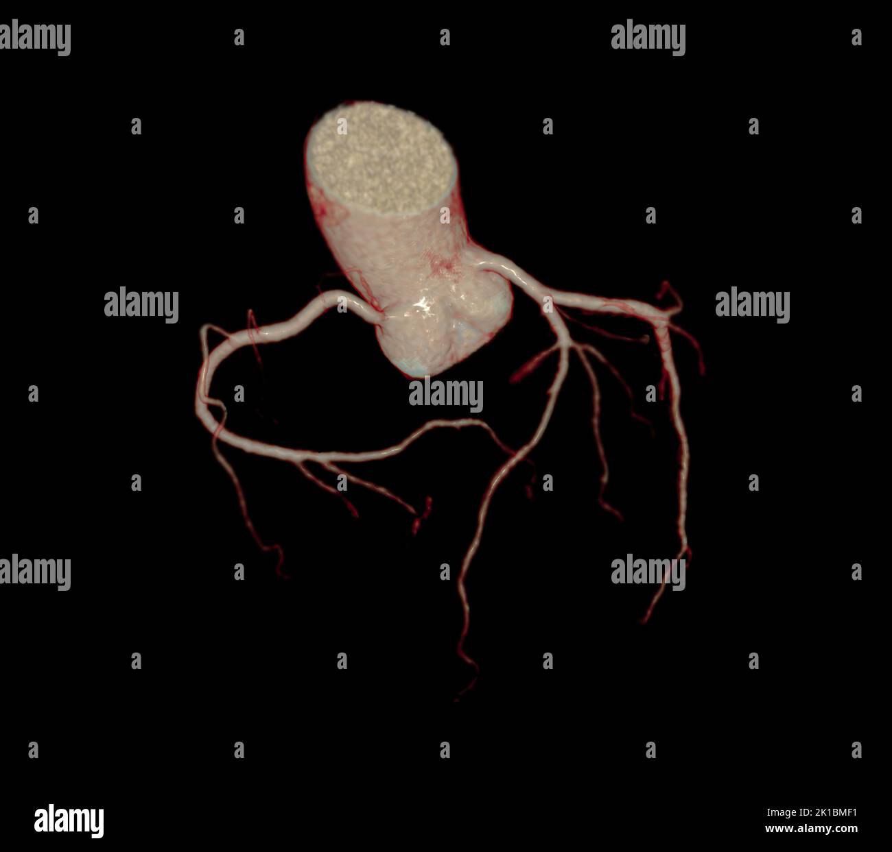 TDM cardiaque 3D ou CTA artère coronaire pour la prévention des ...