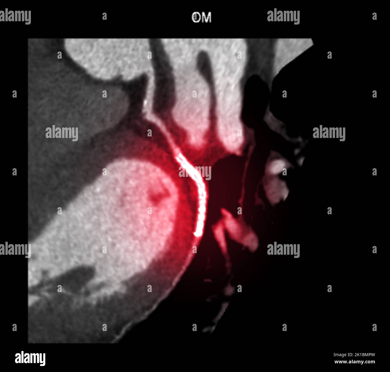 Artère coronaire TDM cardiaque 3D ou CTA montrant des branches ...