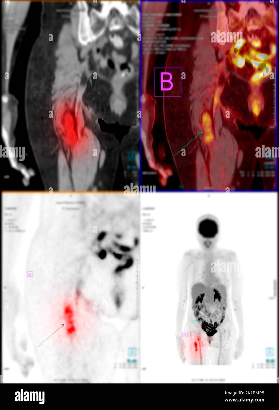 La tomographie par émission de positrons (TEP) CT scan utilise un médicament radioactif (traceur ...