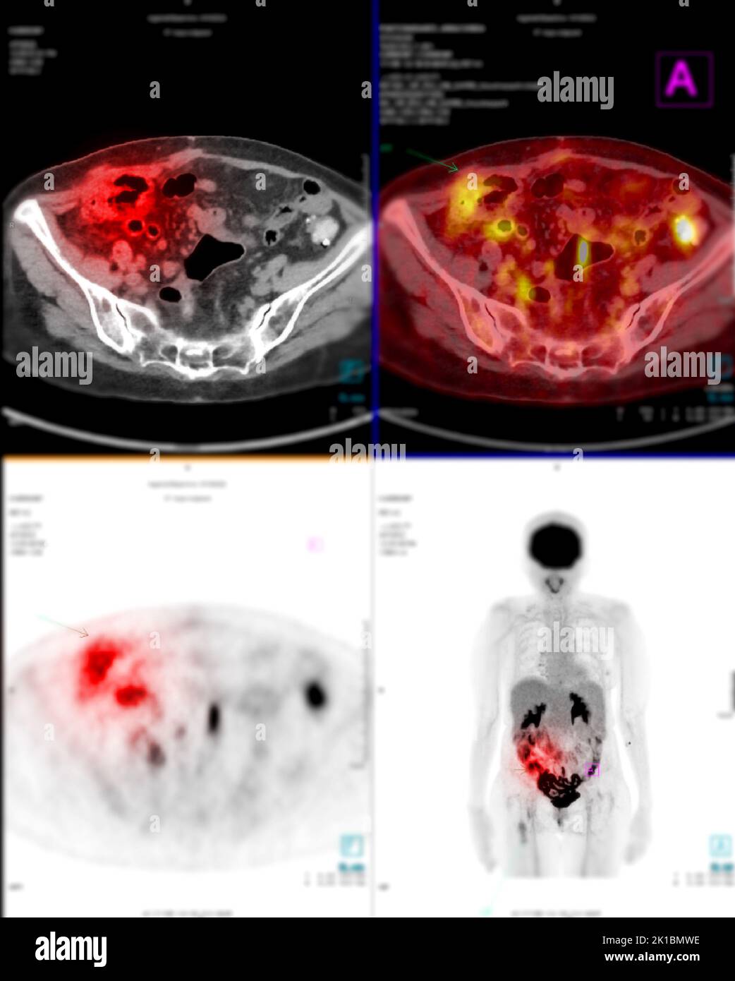 La tomographie par émission de positrons (TEP) CT scan utilise un ...