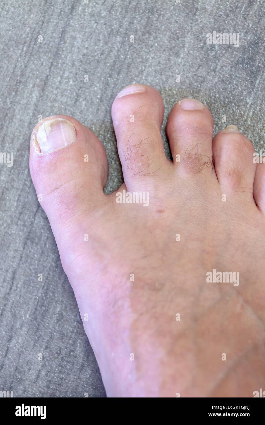 Maladie dermatologique affectant les ongles du pied causée par un ...