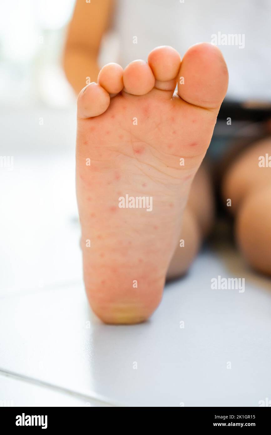 Entérovirus jambe - bras - bouche. Éruption cutanée sur le corps d'un ...
