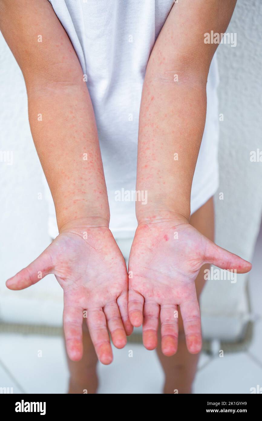 éruption cutanée enfant Banque de photographies et d’images à haute ...