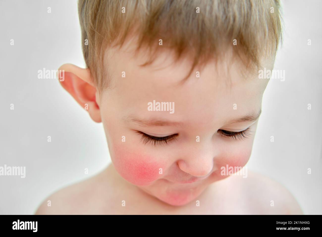 Portrait d'un enfant avec des allergies sur les joues et le menton ...