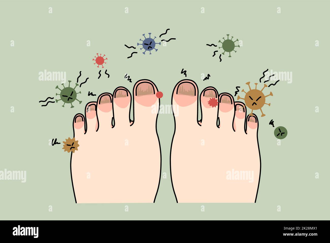 Pieds infectés Banque de photographies et d’images à haute résolution ...