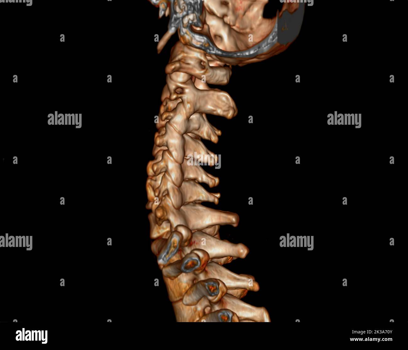 Acquisition CT du rachis cervical ou du rachis cervical 3D rendu pour ...