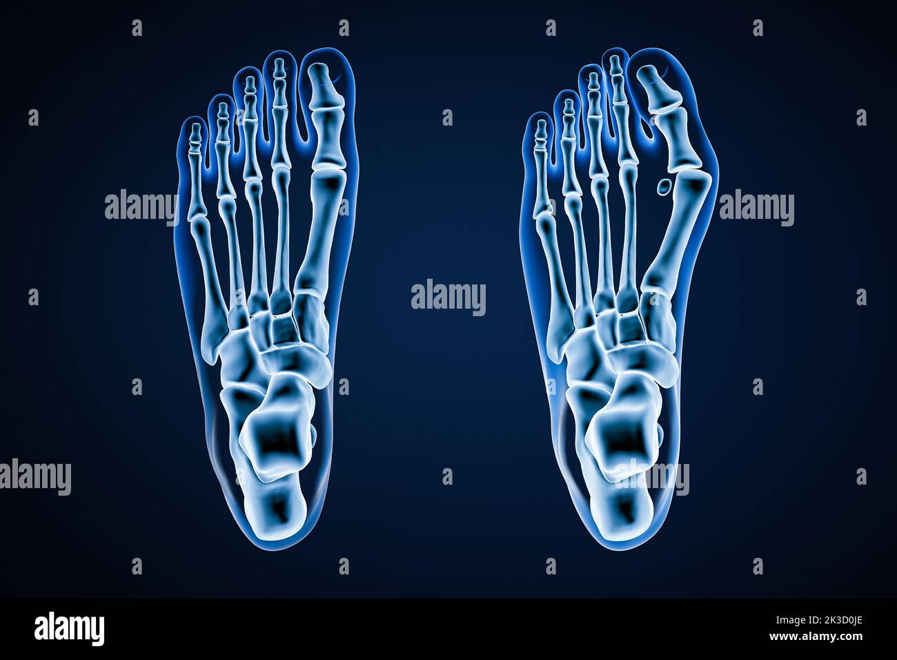 Illustration du rendu de l'hallux valgus ou du bunion x-ray 3D. Vue ...