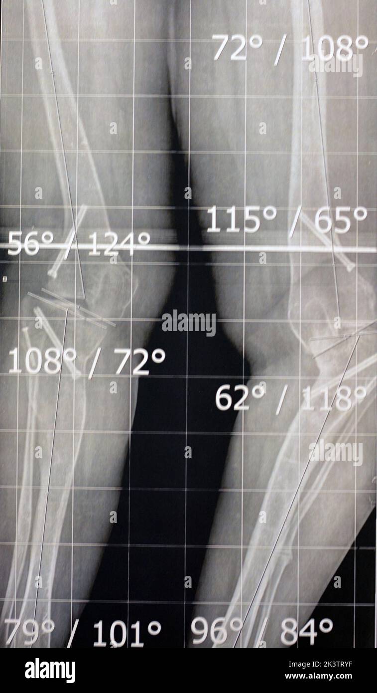 Radiographie de la hanche Banque de photographies et d’images à haute ...
