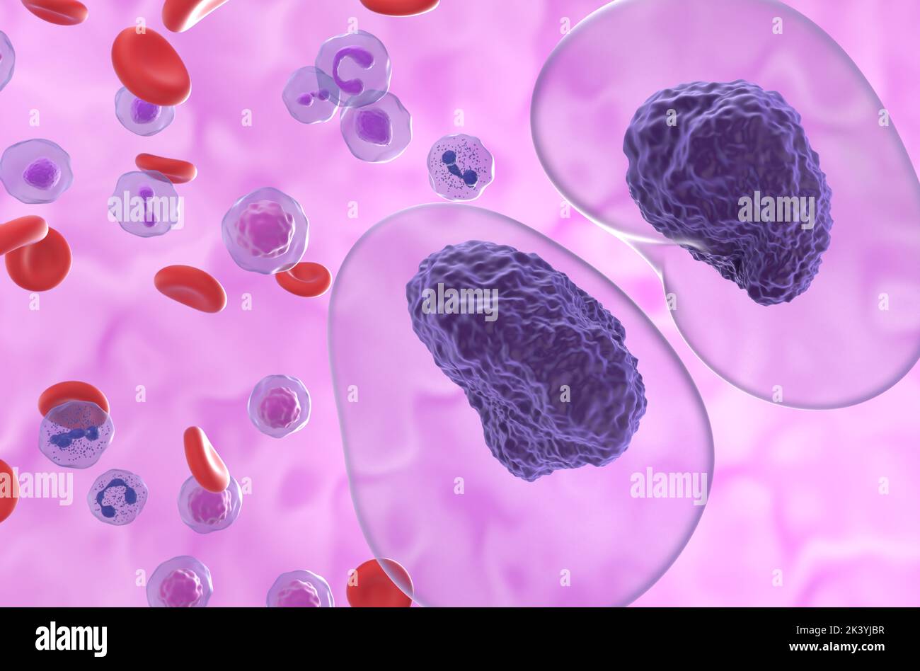 Cellules cancéreuses de la leucémie prolymphocytaire (PLL) - vue de ...