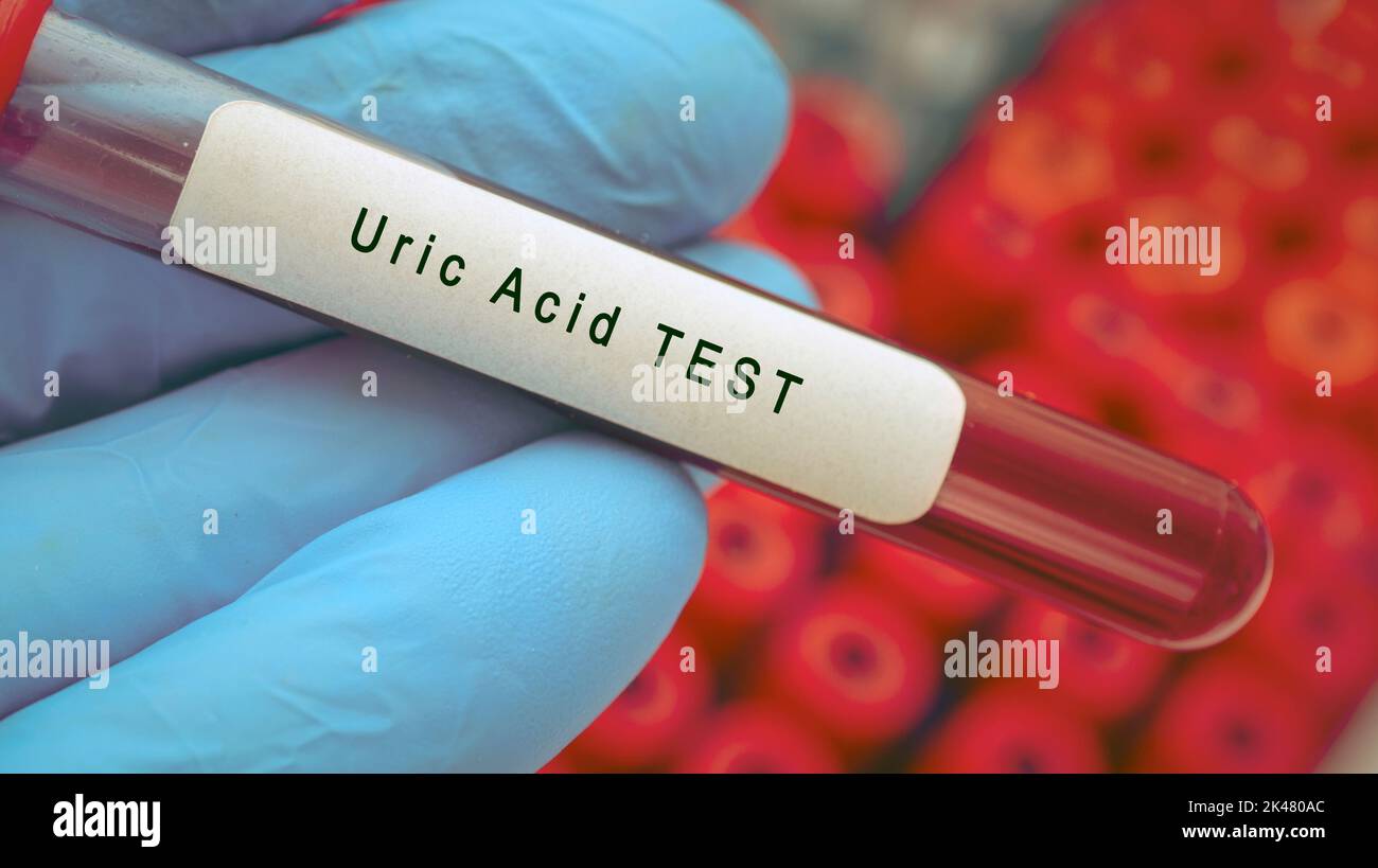 Gouty arthritis Banque de photographies et d’images à haute résolution ...