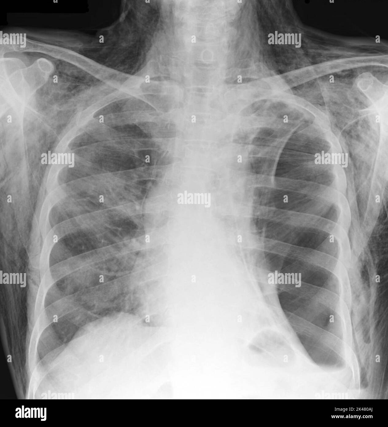 Sub cutaneous Banque de photographies et d’images à haute résolution ...