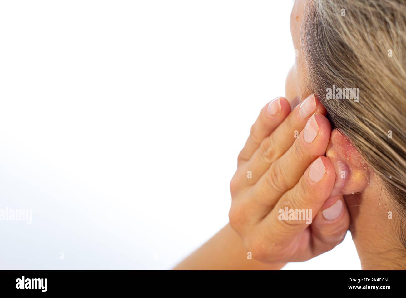 Psoriasis derrière l'oreille. Rougeur psoriasique, écaillage et ...