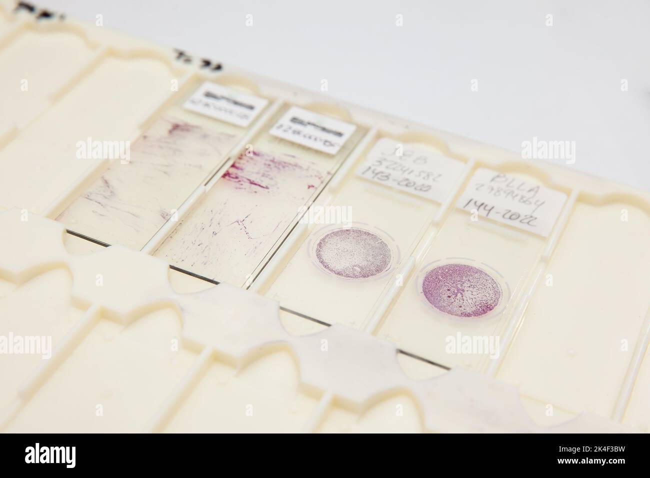 Lames de microscope cytologiques traditionnelles et liquides pour test ...