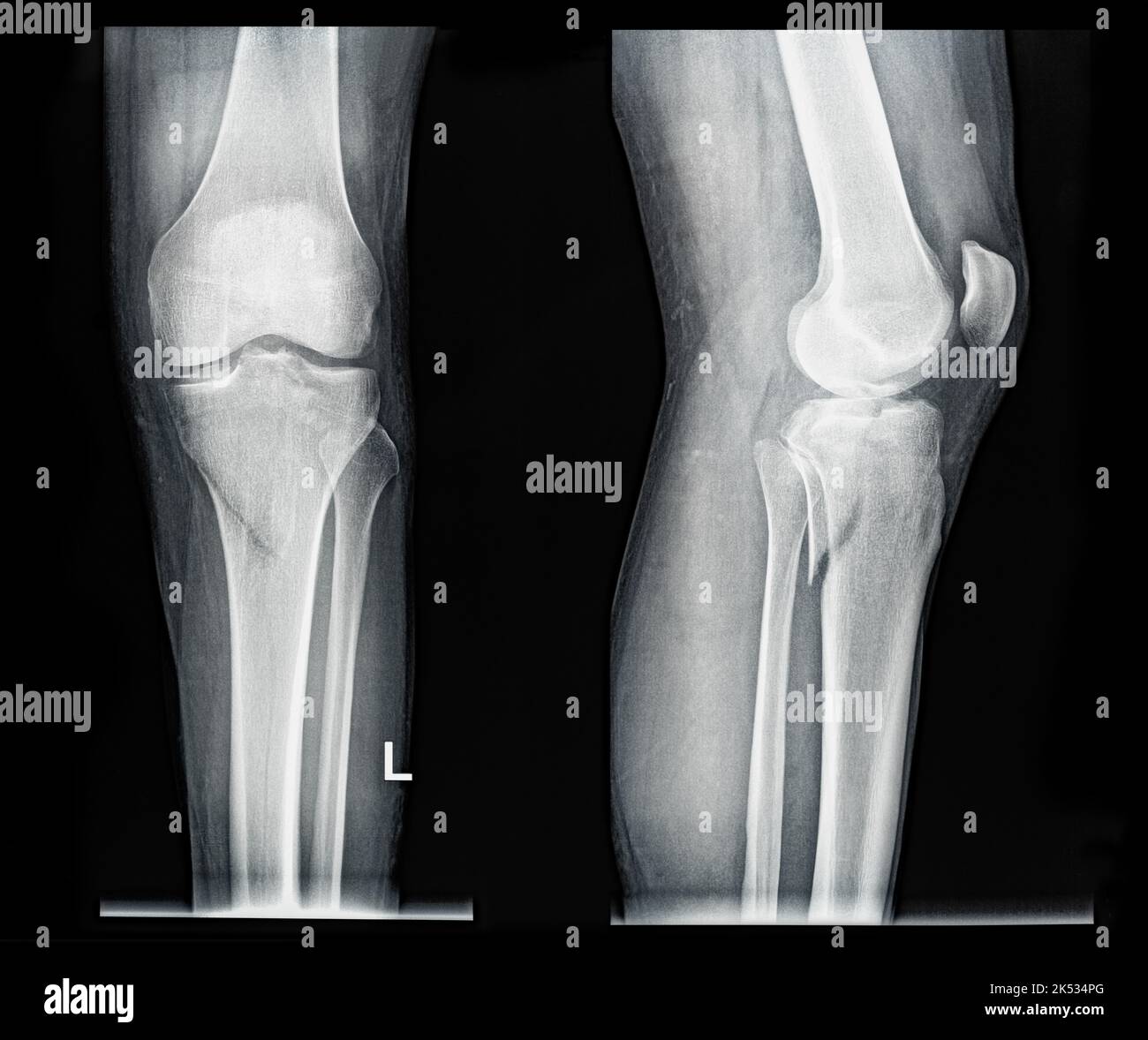 Images IRM à rayons X montrant une fracture réelle de l'os de la jambe ...
