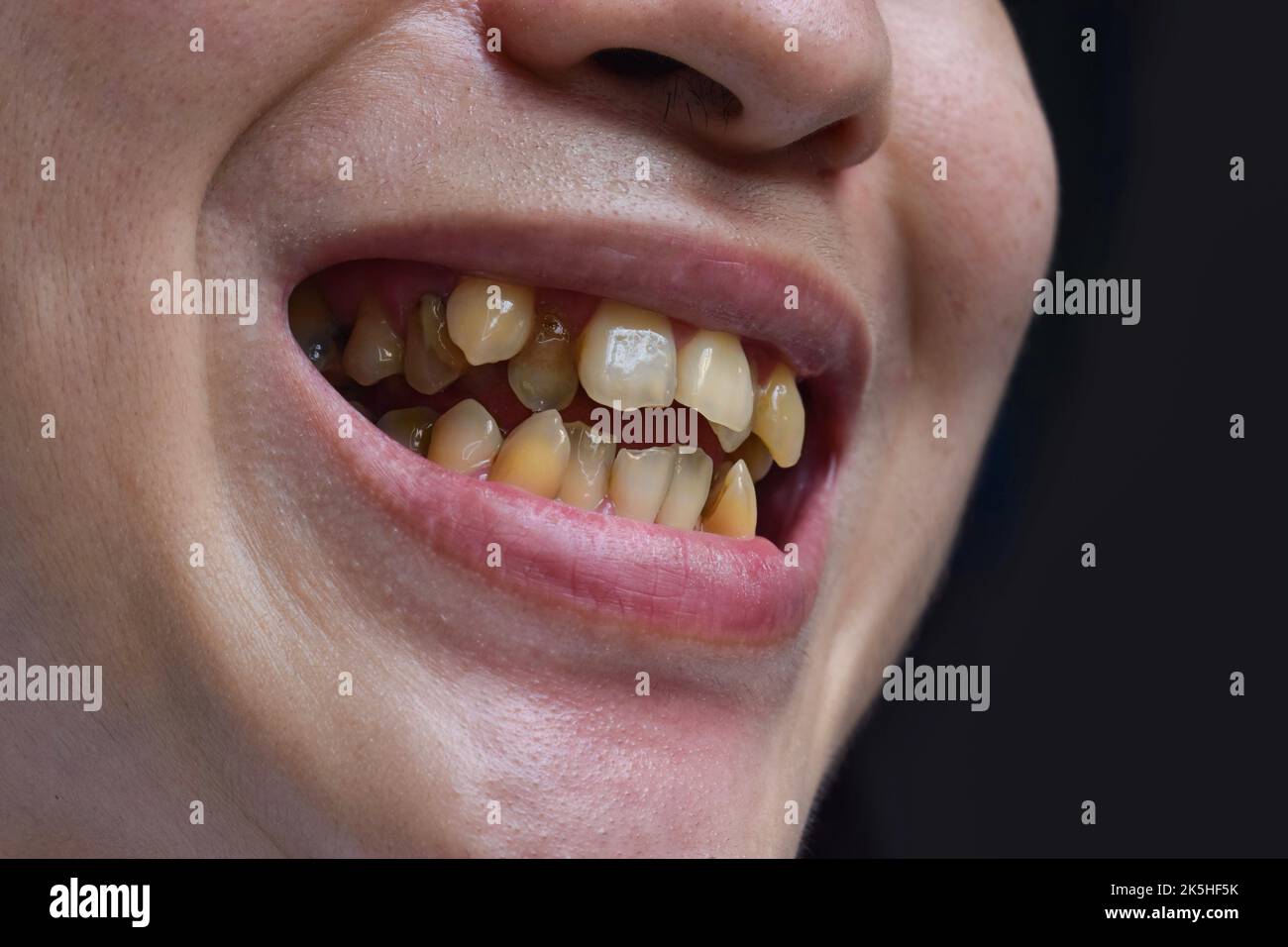 Teeth staining Banque de photographies et d’images à haute résolution ...