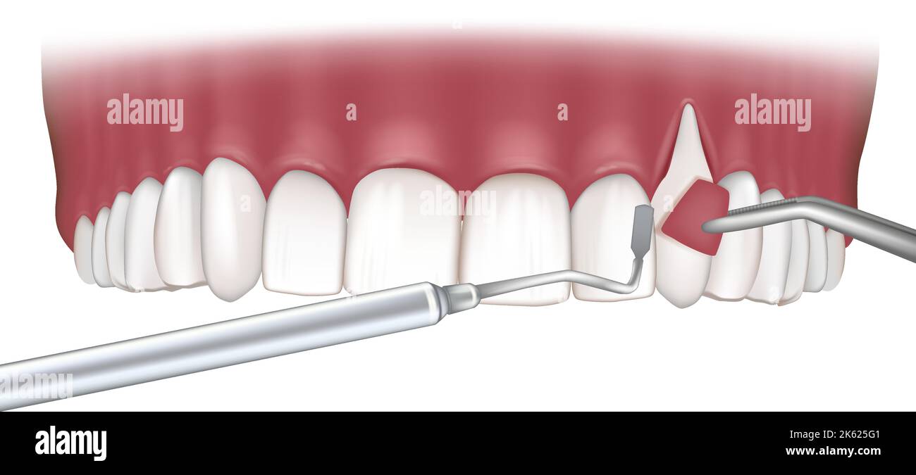 Traitements de la récession gingivale. Greffe de tissus mous dans la ...