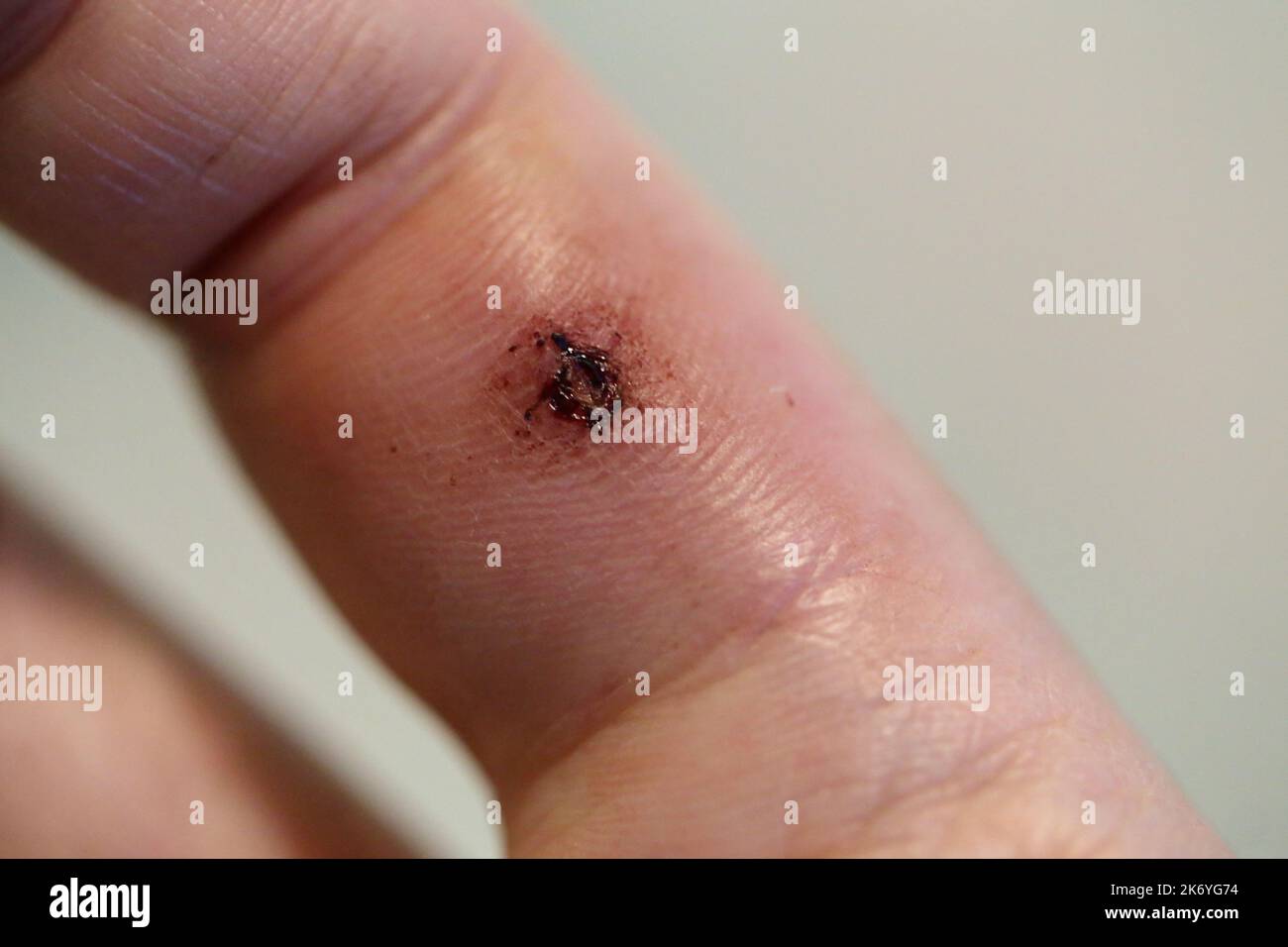 Morsure de chien sur une personne Banque de photographies et d’images à ...