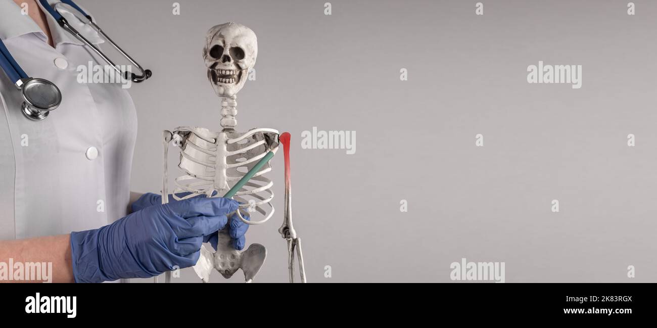 Concept de douleur d'épaule. Inflammation de l'acromion, fracture sur ...