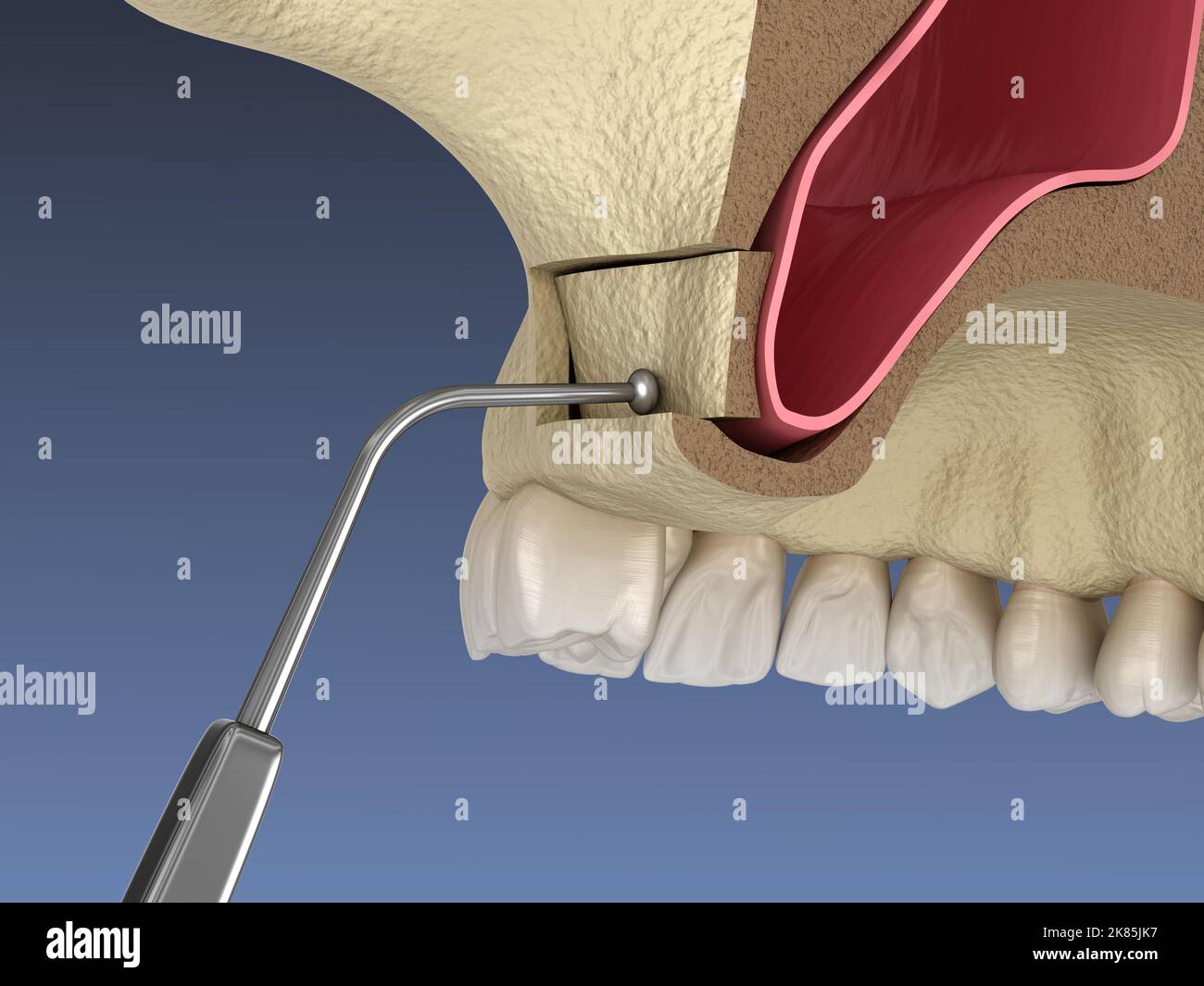 Chirurgie de l'élévation des sinus - déplacement de la membrane ...