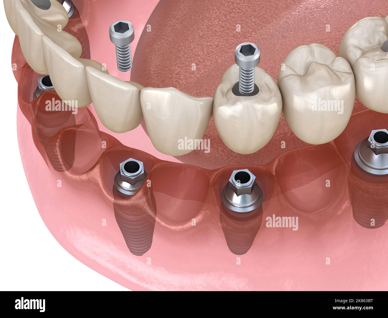 Prothèse mandibulaire, système All On 4 supporté par des implants ...