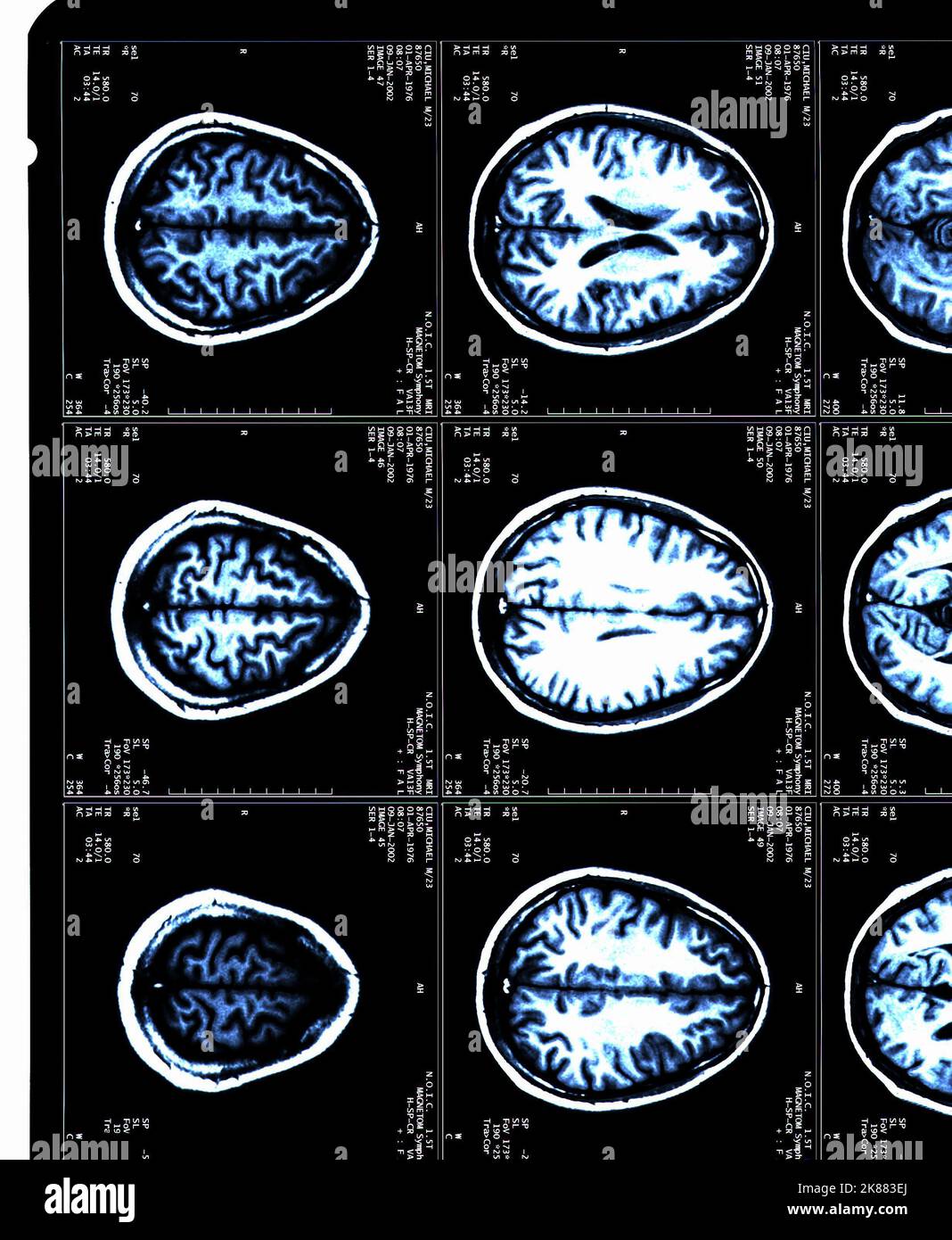 Examens IRM du cerveau d'un patient atteint de sclérose en plaques ...