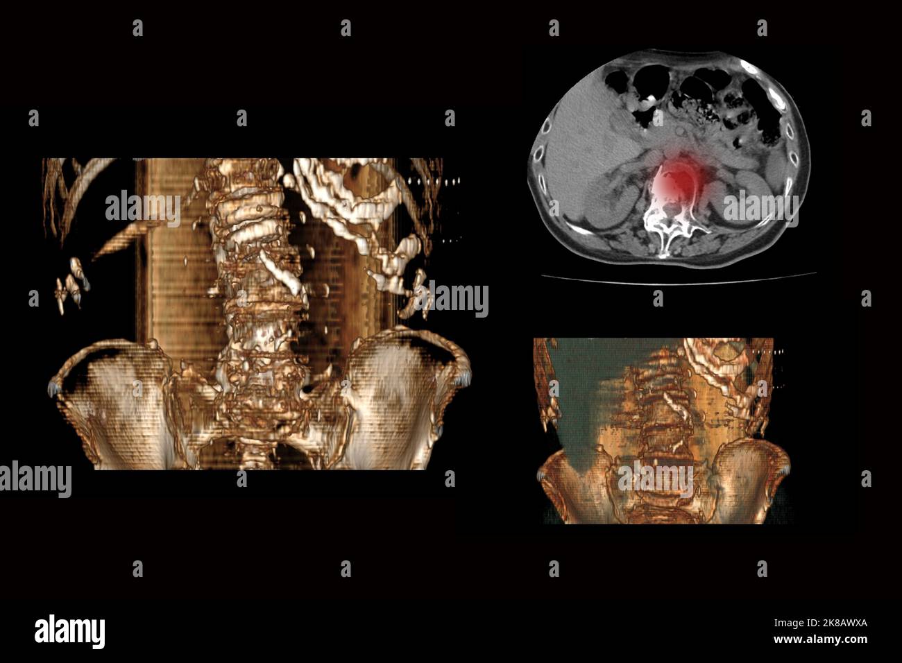 tomodensitométrie de la colonne vertébrale avec une fracture des ...