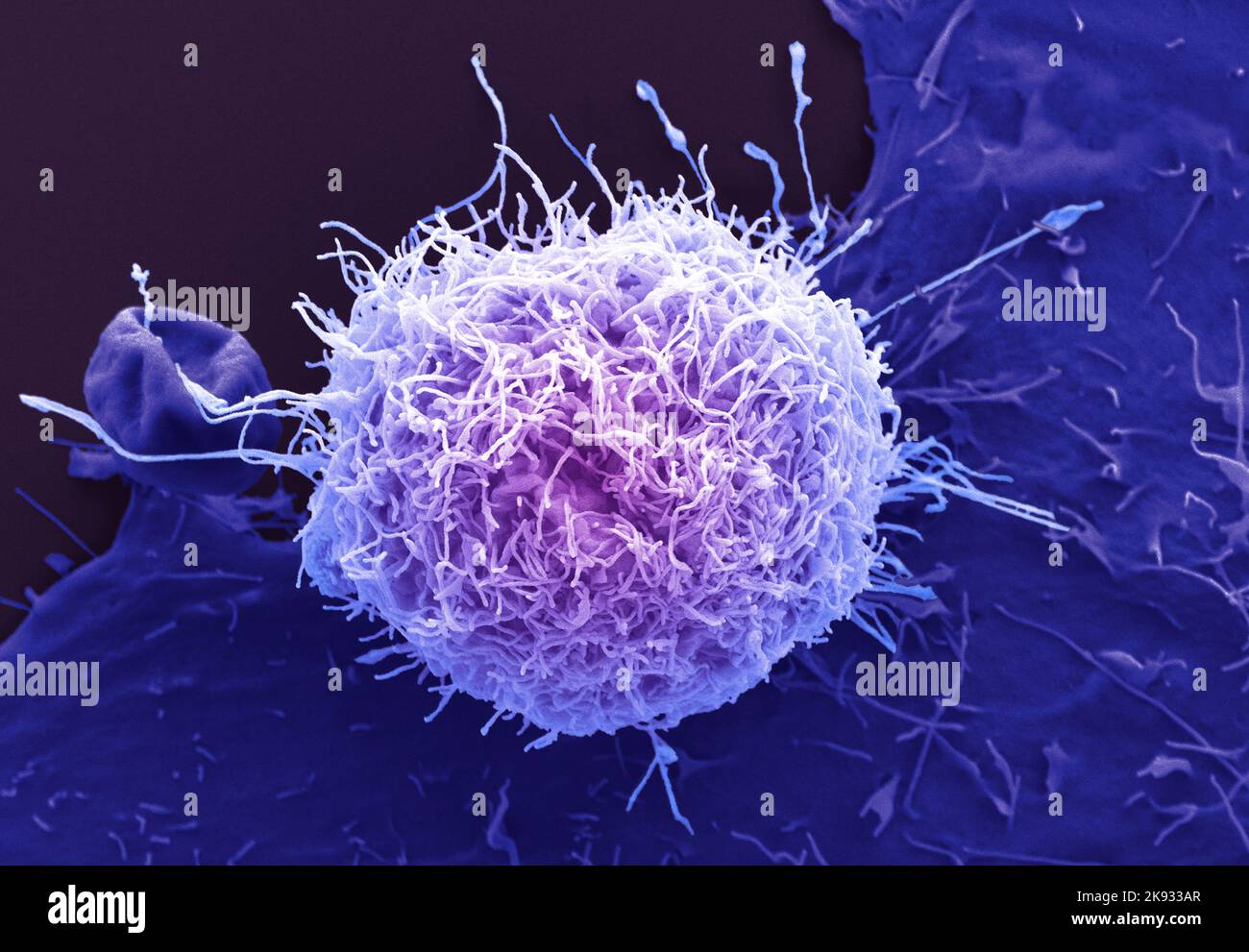 Cellules du cancer du col de l'utérus, SEM Photo Stock - Alamy