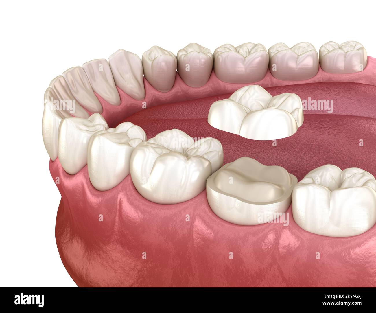Fixation de la couronne en céramique Onlay sur la dent molaire. 3D ...