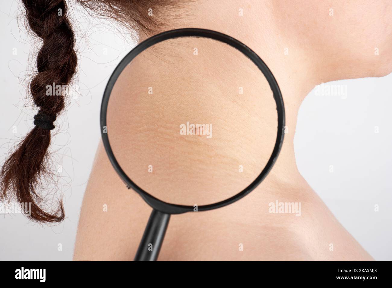 Mélanome benin Banque de photographies et d’images à haute résolution - Alamy