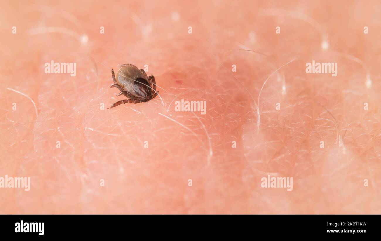 Les cerfs parasites tick mordu dans la peau humaine à sucer le sang ...