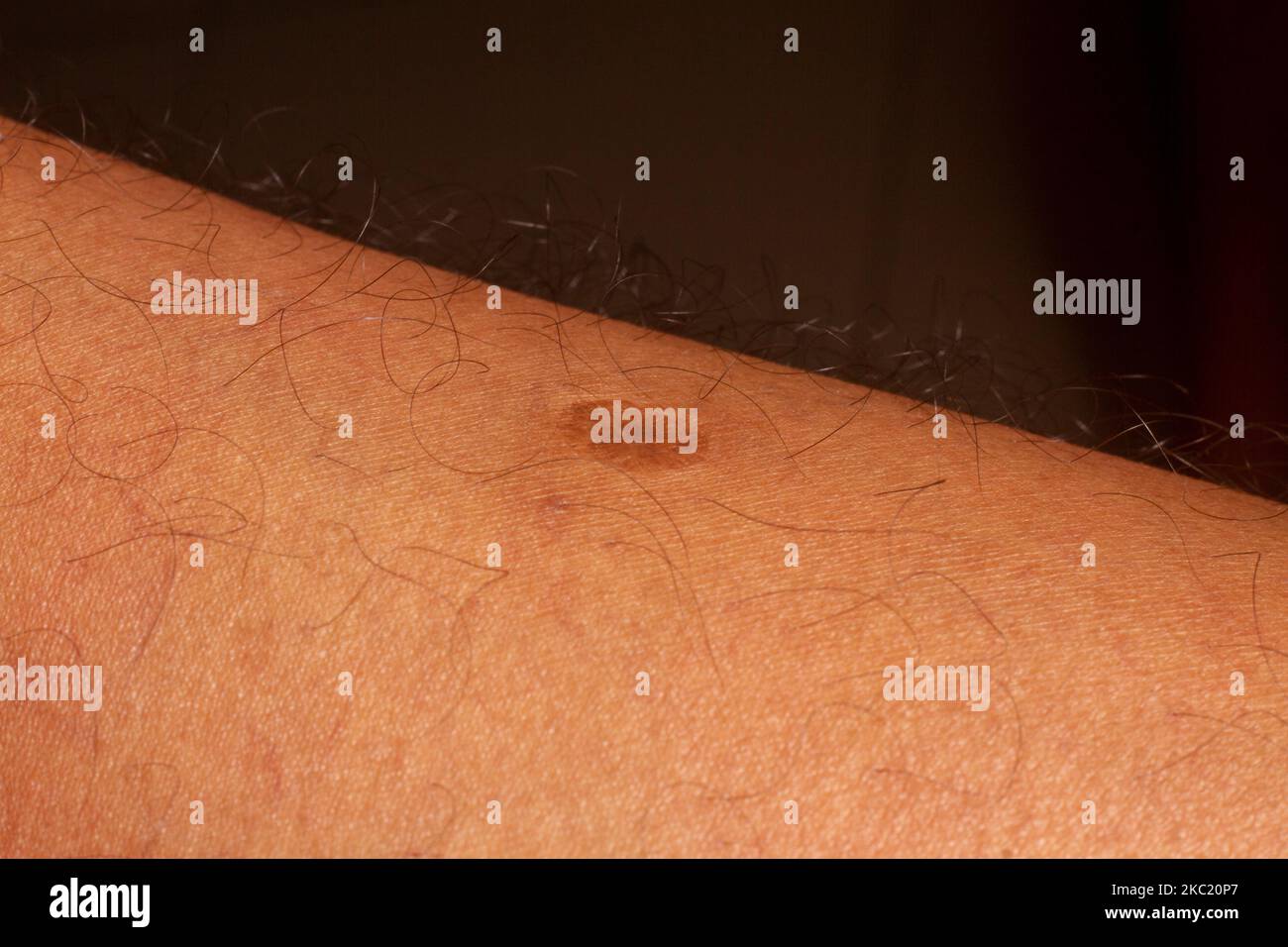 Mélanome benin Banque de photographies et d’images à haute résolution - Alamy