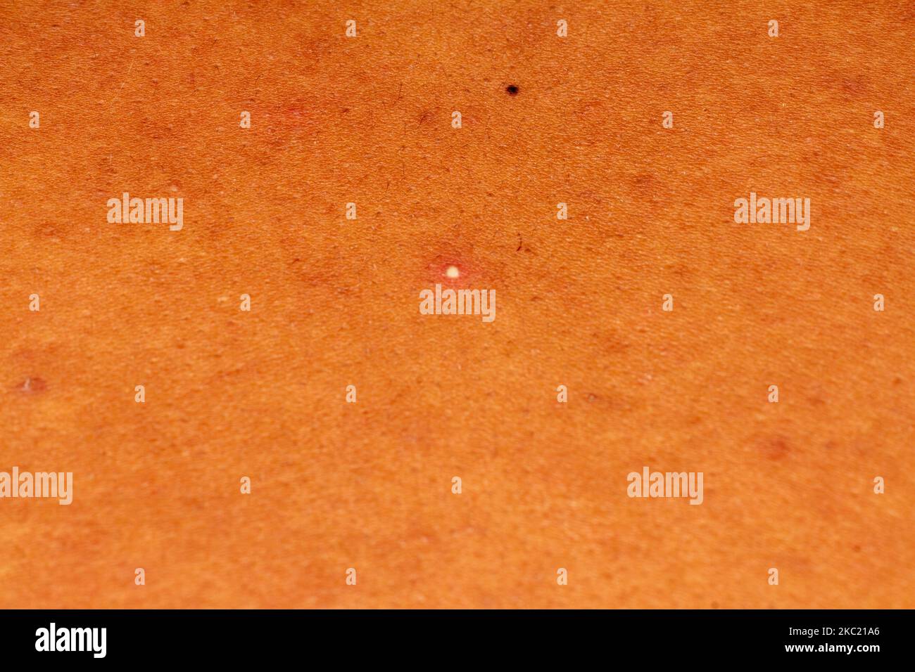 Mélanome benin Banque de photographies et d’images à haute résolution - Alamy